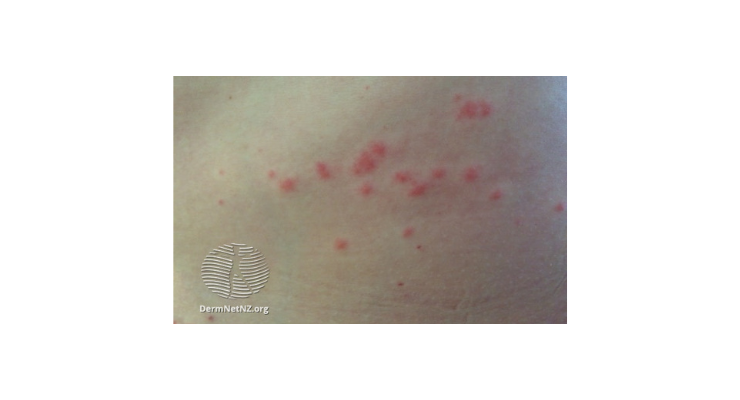 Summer rashes: How to protect against & treat common skin irritations ...