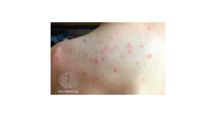 Summer rashes: How to protect against & treat common skin irritations ...