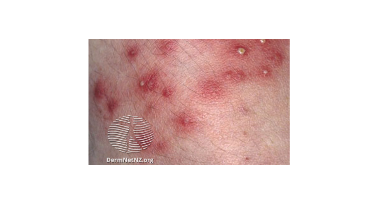 Summer rashes: How to protect against & treat common skin irritations ...