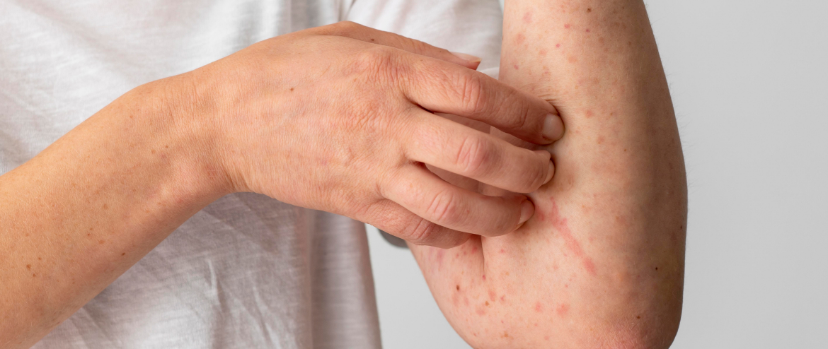 Saiba mais sobre a Varíola Monkeypox | Hospital Sírio-Libanês