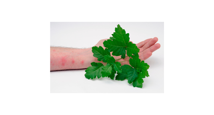 Summer rashes: How to protect against & treat common skin irritations ...