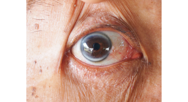 What are the signs and symptoms of hyperlipidemia? | HealthTap Blog