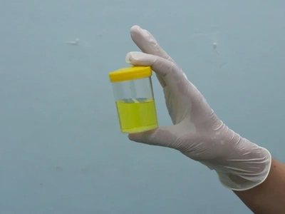 Can a urine test detect STDs? | STDWatch.com