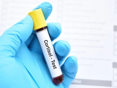 What Is A Cortisol Test? | STDWatch.com