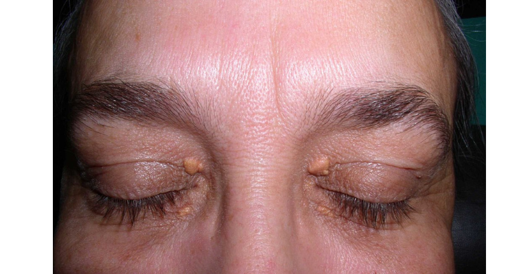 What are the signs and symptoms of hyperlipidemia? | HealthTap Blog